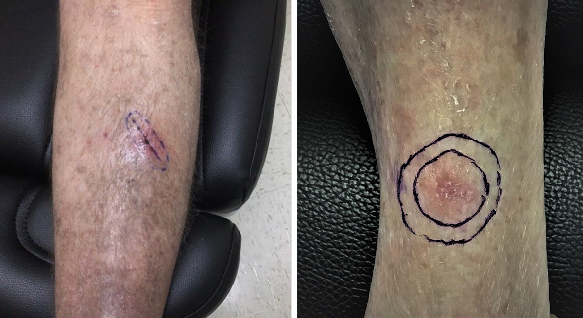 Skin Cancer on Legs: Signs, Early Stages & Treatment