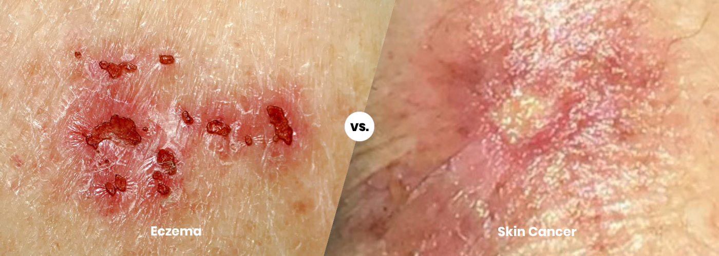 Can Eczema be Confused with Skin Cancer? | Eczema or Skin Cancer ...