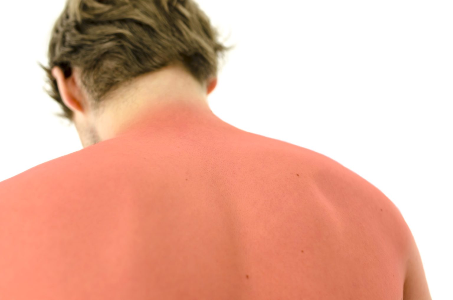 Does Sunburn Cause Skin Cancer? | GentleCure