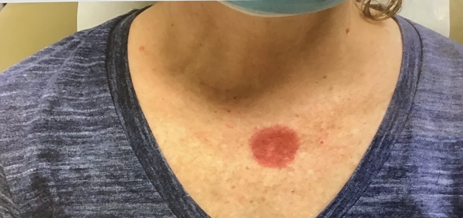 Warts vs. Skin Cancer | Can a Wart Be Skin Cancer?