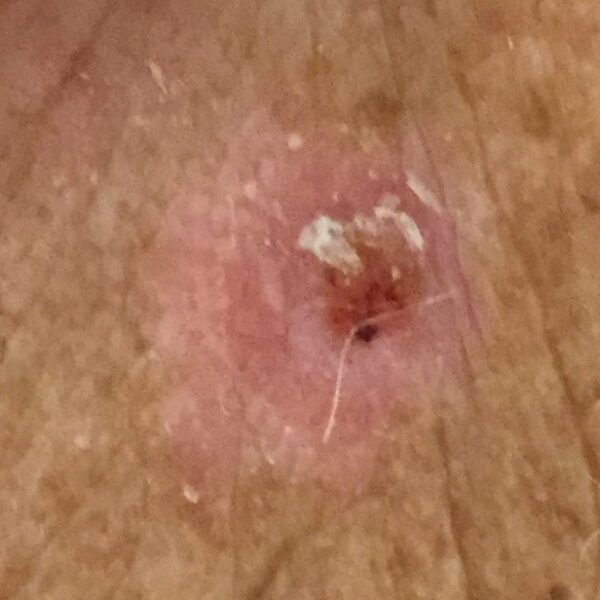 Visual Side Effects of Image-Guided Superficial Radiotherapy | GentleCure